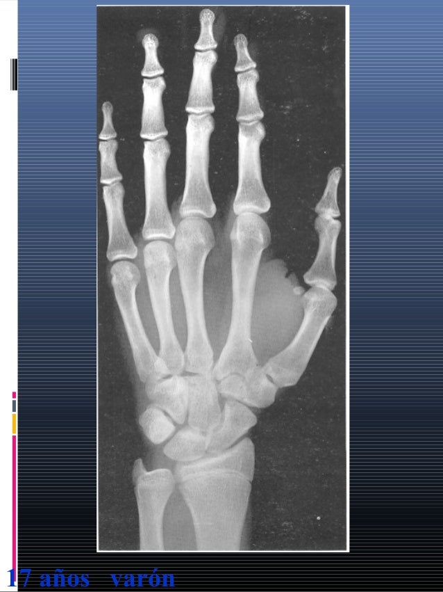 Edad osea en los niños