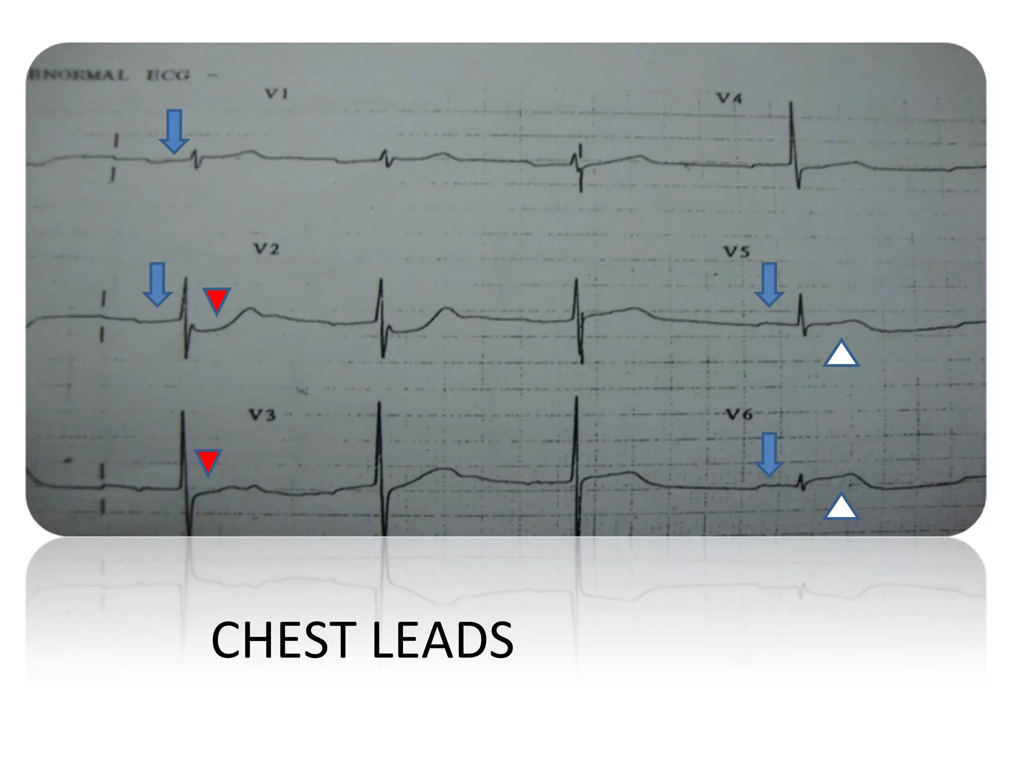 ECG: Atrial Infarct | PPT