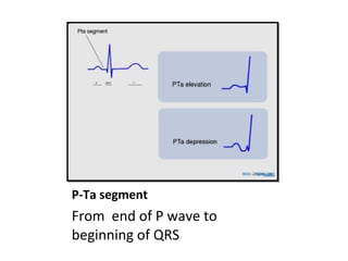 ECG: Atrial Infarct | PPT