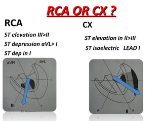 ECG: Atrial Infarct | PPT