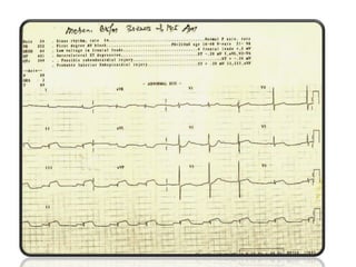 ECG: Atrial Infarct | PPT