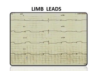 ECG: Atrial Infarct | PPT