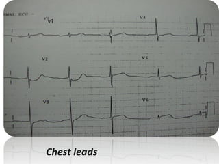 ECG: Atrial Infarct | PPT