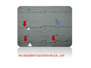 ECG: Atrial Infarct | PPT