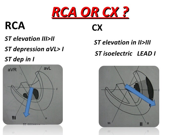 ECG: Atrial Infarct