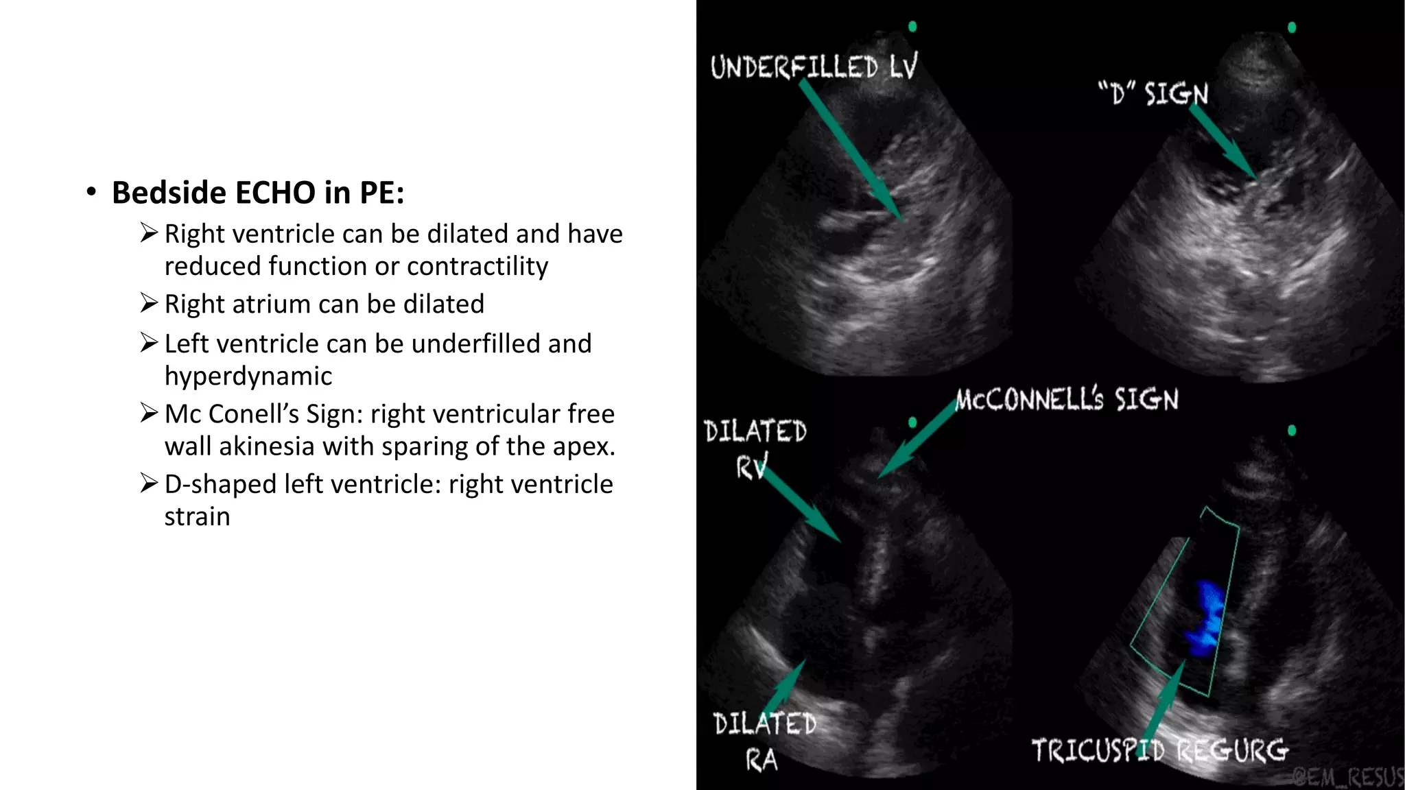 Approach to chest pain | PDF