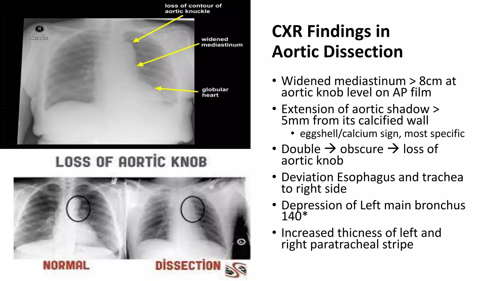 Approach to chest pain | PDF