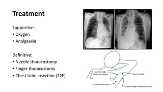 Approach to chest pain | PDF