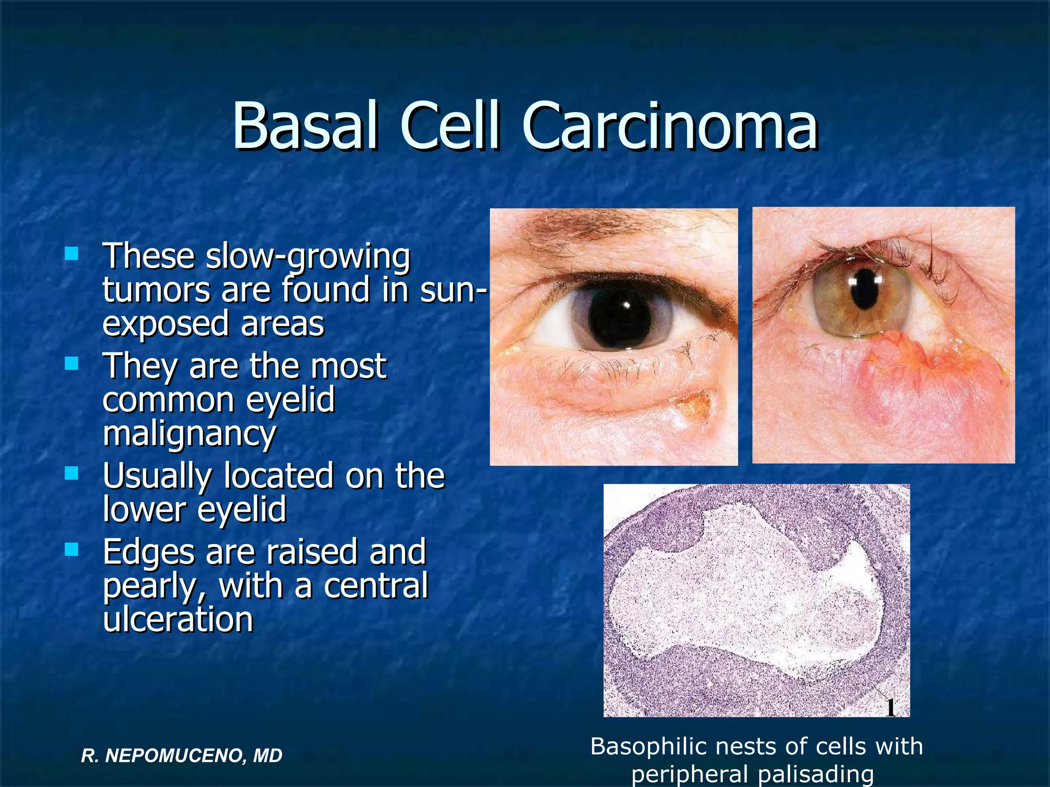 Ed&cornea lecture fatima | PPT