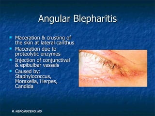 Angular Blepharitis