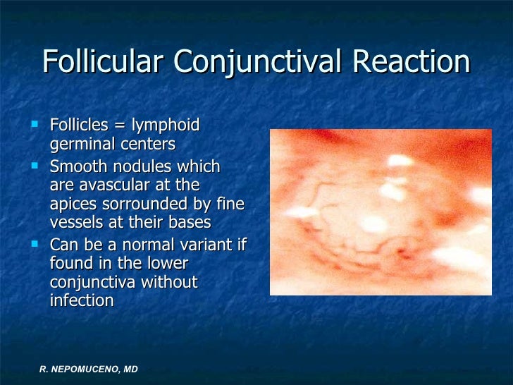 Follicular Vs Papillary Conjunctivitis