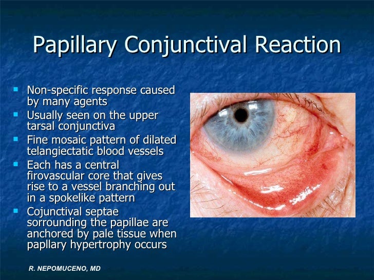 Follicular Vs Papillary Conjunctivitis