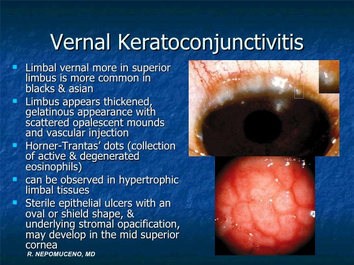 Ed&cornea lecture fatima
