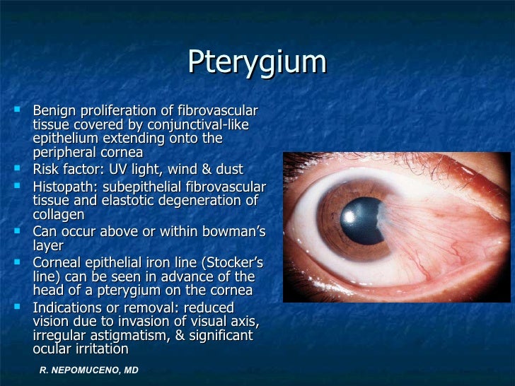 Ed&cornea lecture fatima