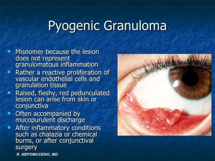 Ed&cornea lecture fatima