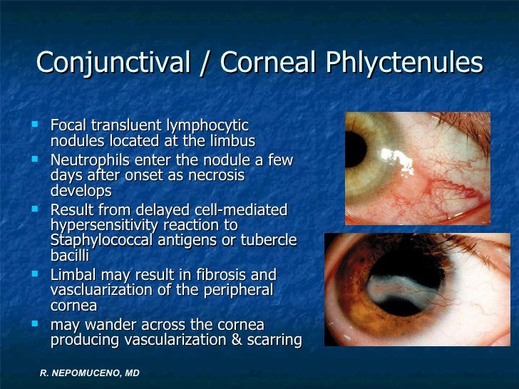 Ed&cornea lecture fatima