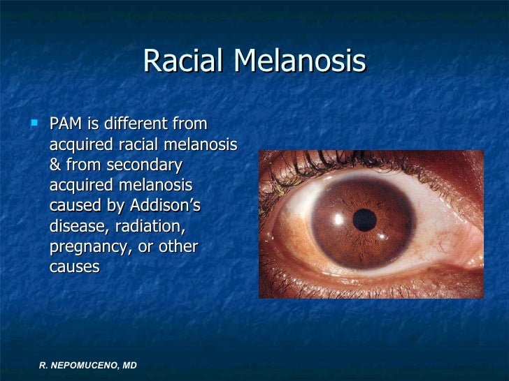 Racial Melanosis Scleral And Conjunctival Pigmentation | Basicmedical