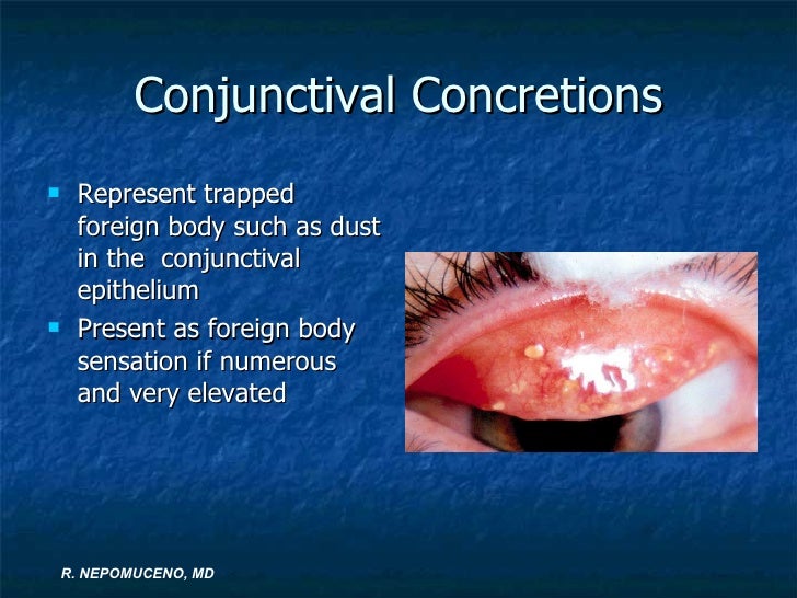 Ed&cornea lecture fatima