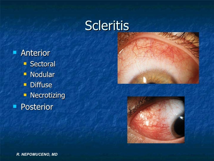 Ed&cornea lecture fatima
