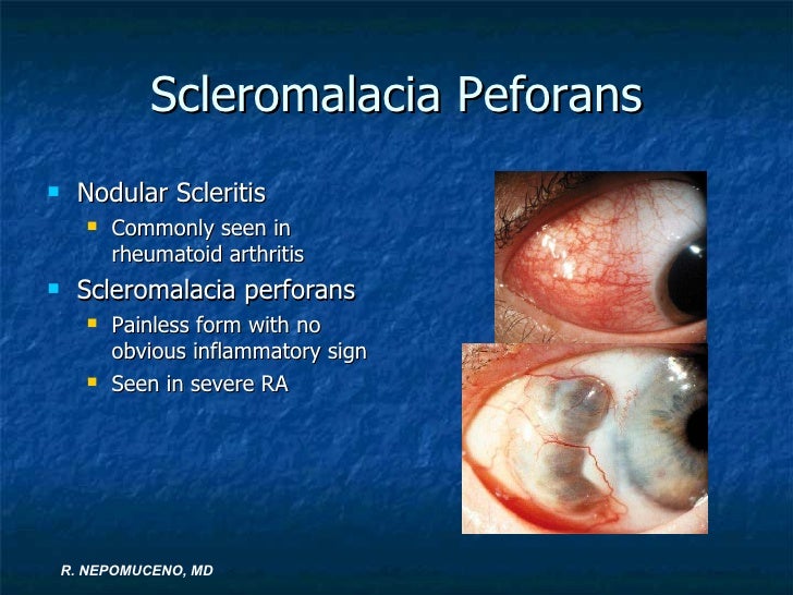 Ed&cornea lecture fatima