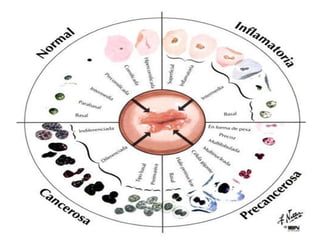 Comprehensive Overview of Premalignant Cervical Lesions: Diagnosis ...