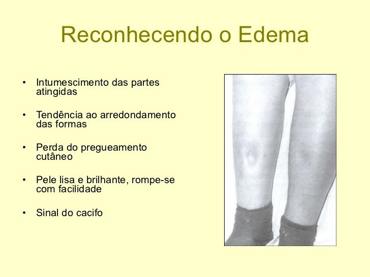 Edema