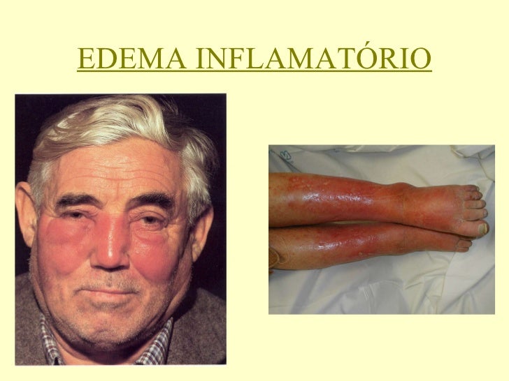 Edema