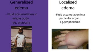 Edema ppt (definition , types of edema and more).pptx