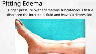 Edema complete details ppt (definition, types).pptx