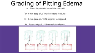 Edema complete details ppt (definition, types).pptx