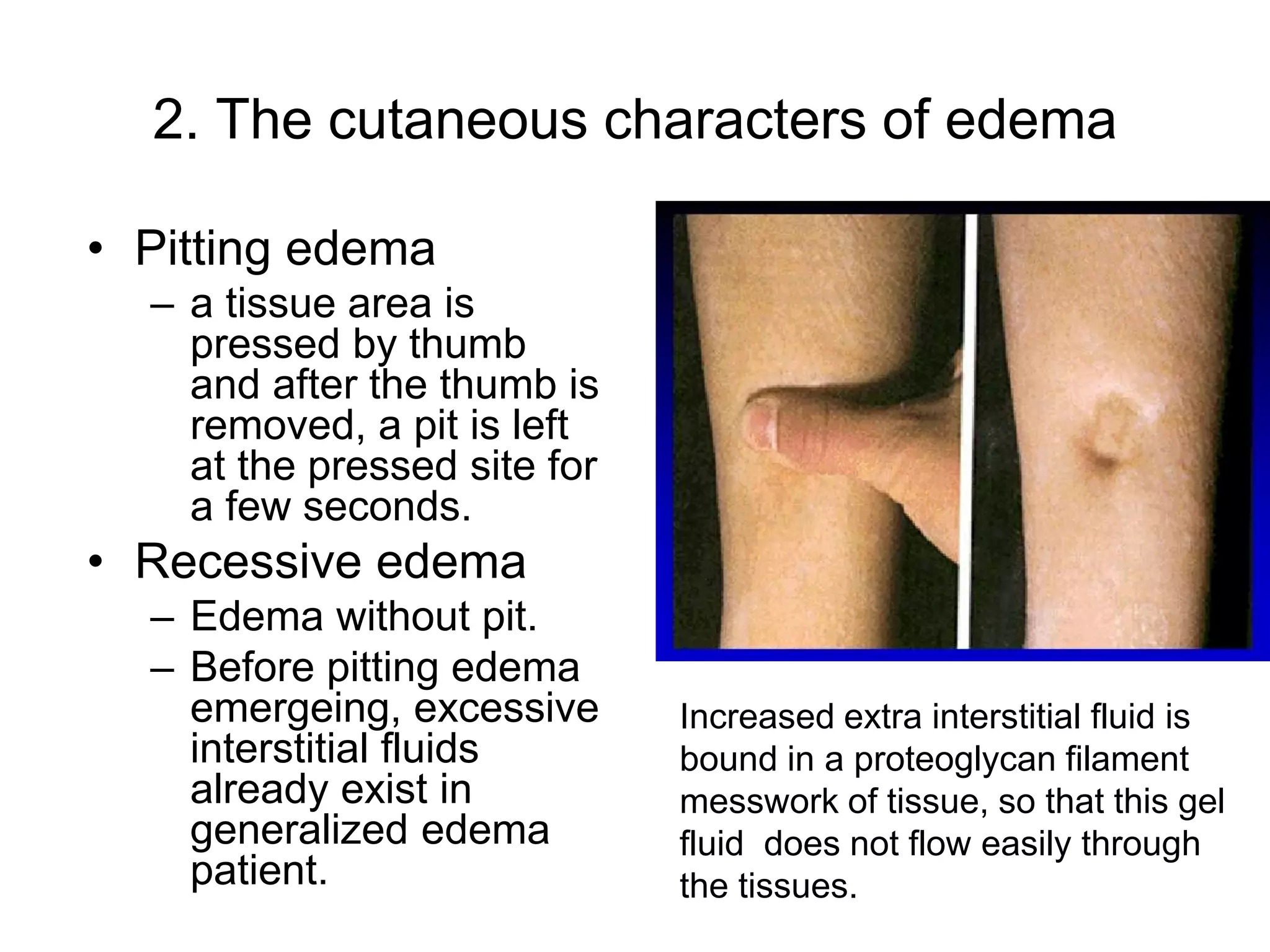 Edema | PPT