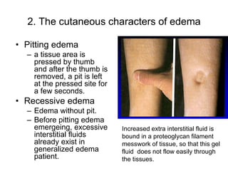 Edema | PPT