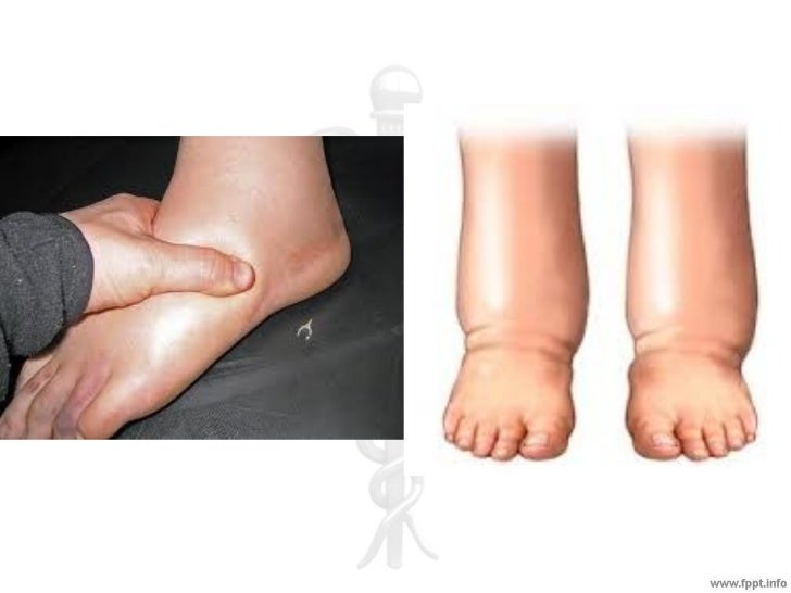 Diocese Verona Pretibial Edema