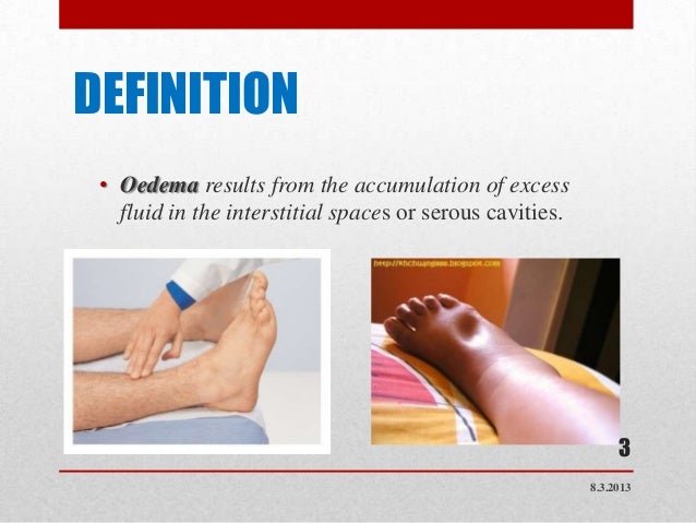 Edema