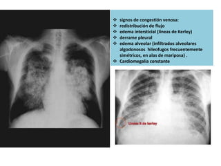 Edema agudo pulmonar | PPTX