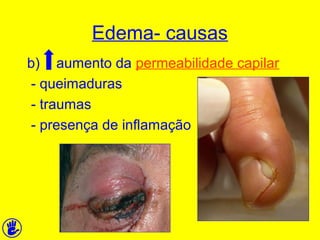 Edema - tipos e exemplos | PPT