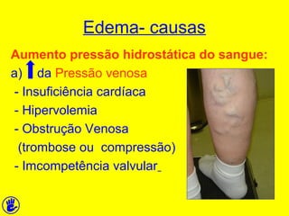 Edema: Causas, Tipos, Sintomas E Tratamentos – SKWMJ