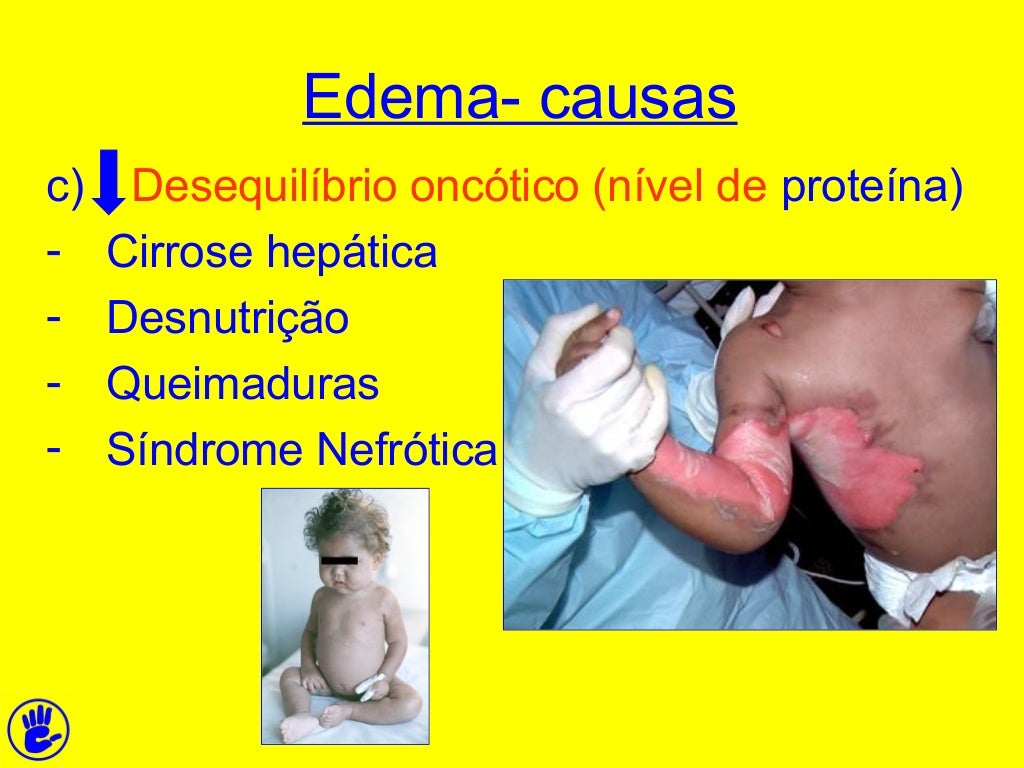 Você Conhece Os Diferentes Tipos De Edema? – ZKRJU