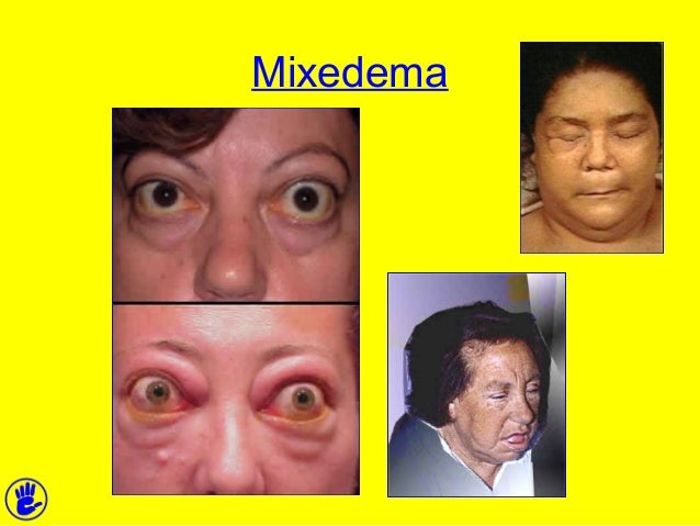 Edema - tipos e exemplos