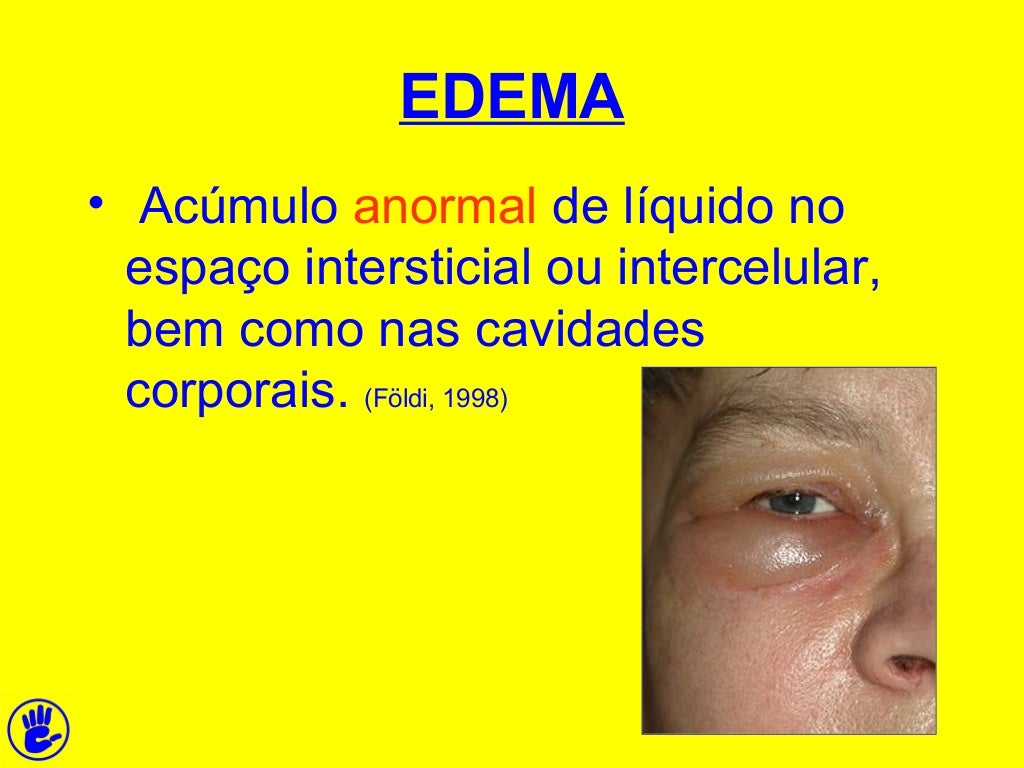 Edema - tipos e exemplos