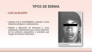 Edema | PPTX