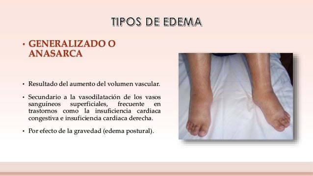 Edema