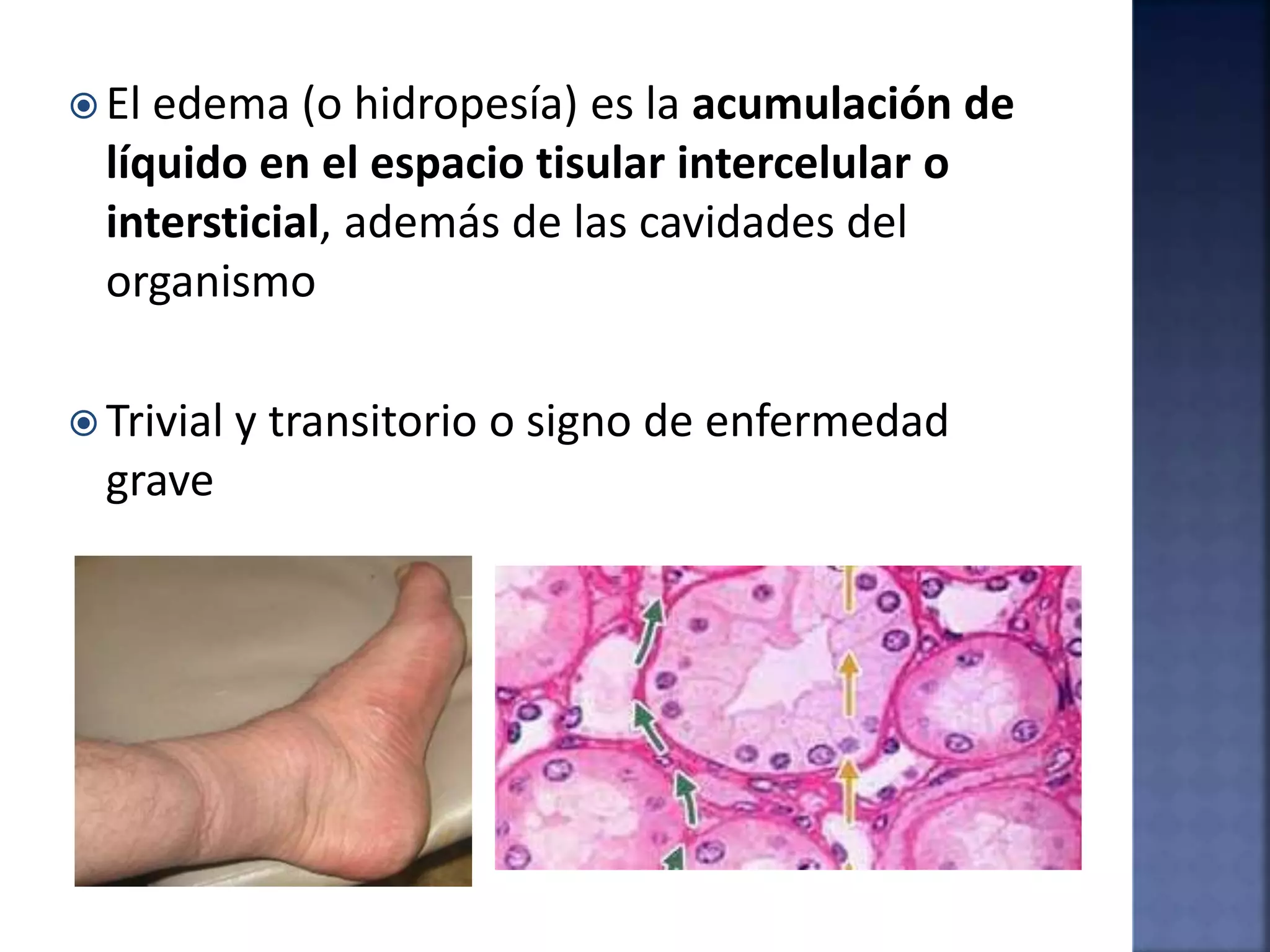 Edema | PPTX