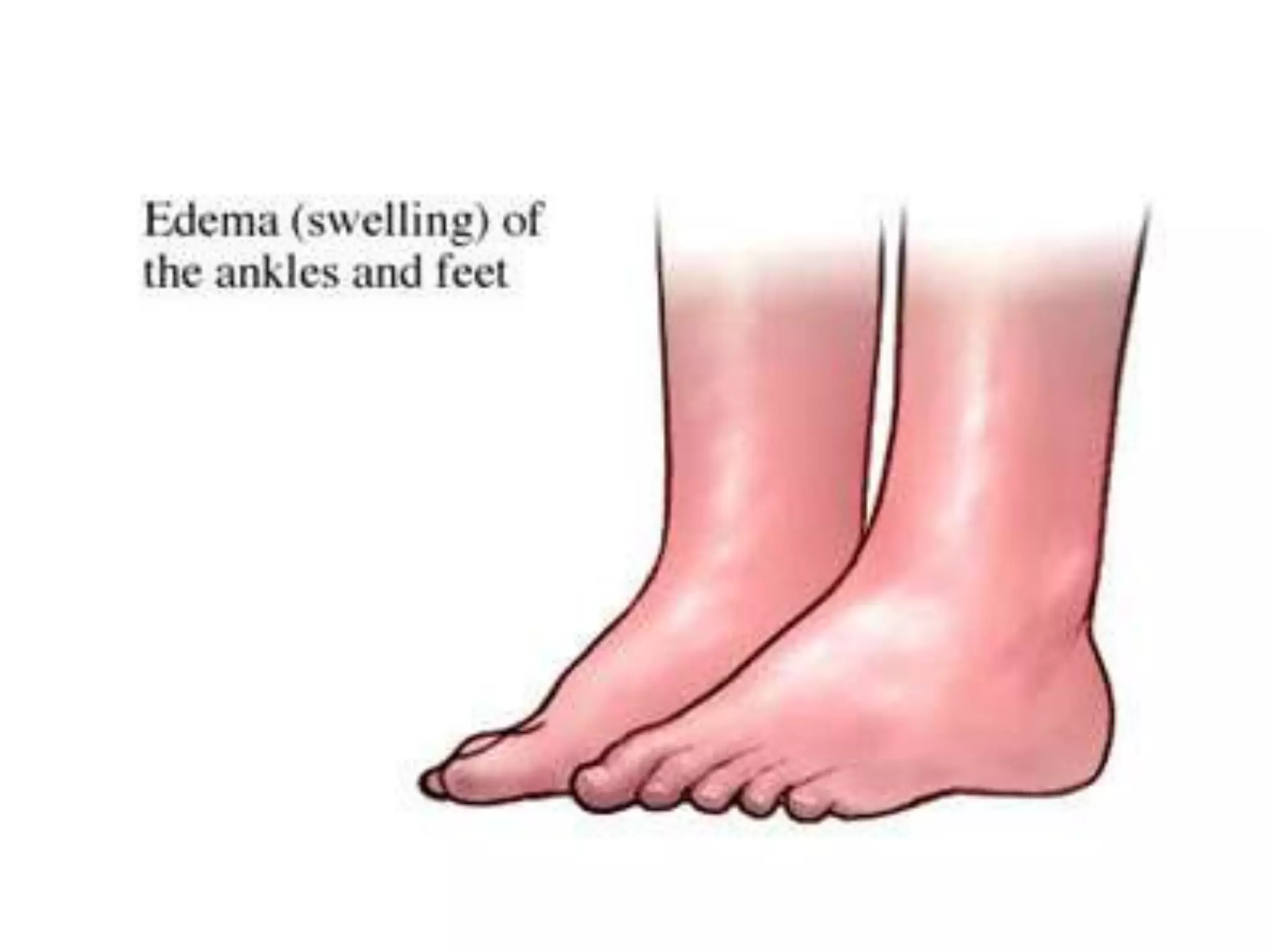 Edema | PPTX