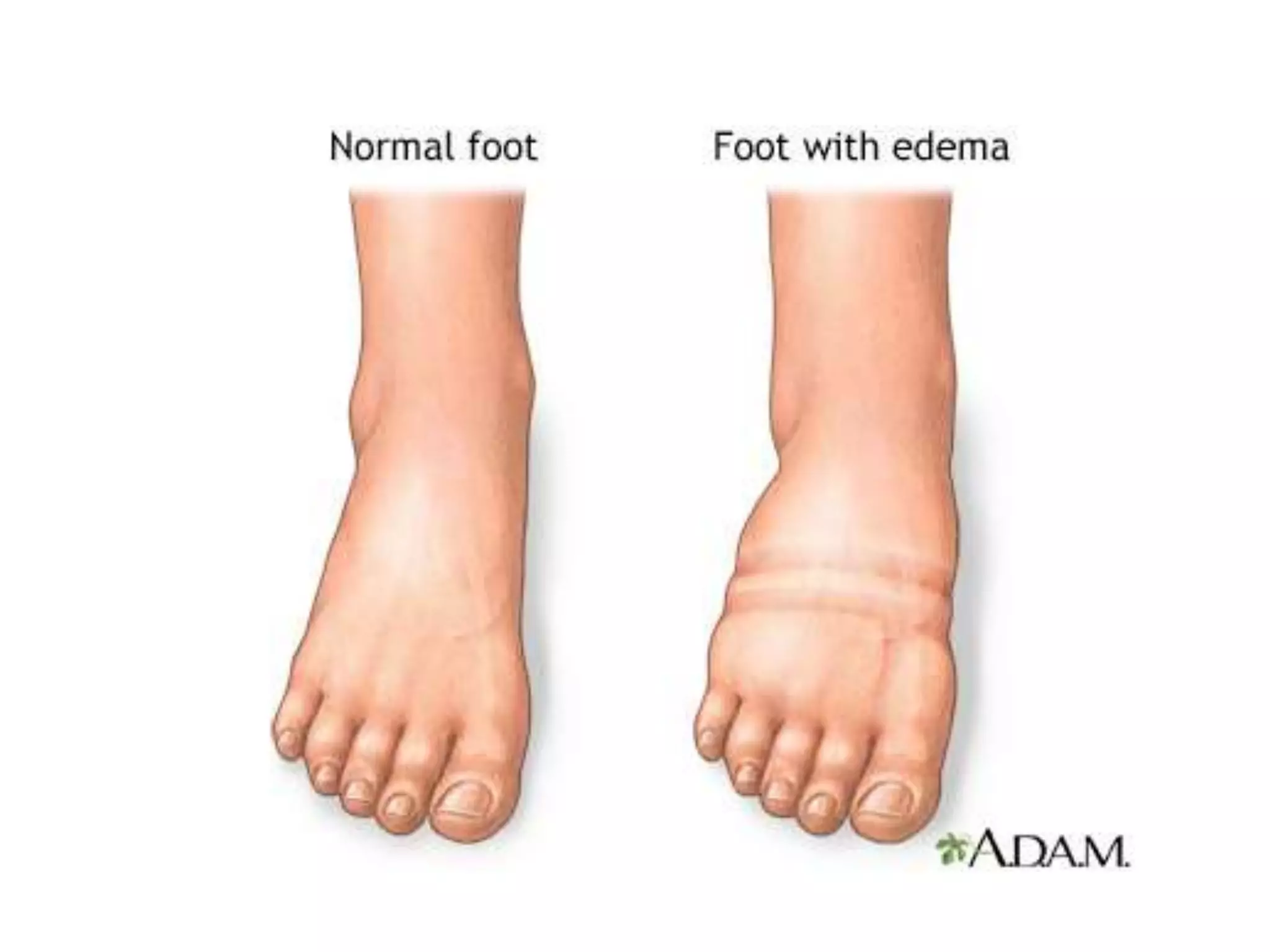 Edema | PPTX