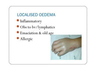 Edema | PPTX