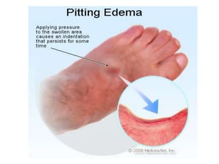 Edema | PPTX