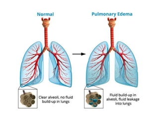Edema | PPTX