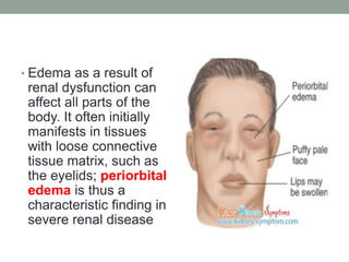 Edema | PPTX