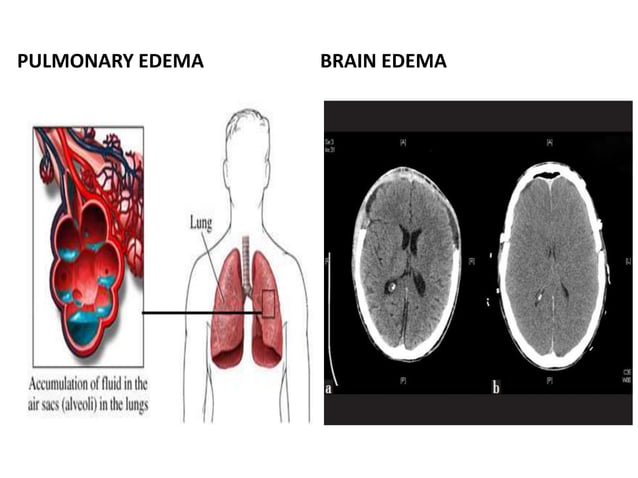 Edema | PPT